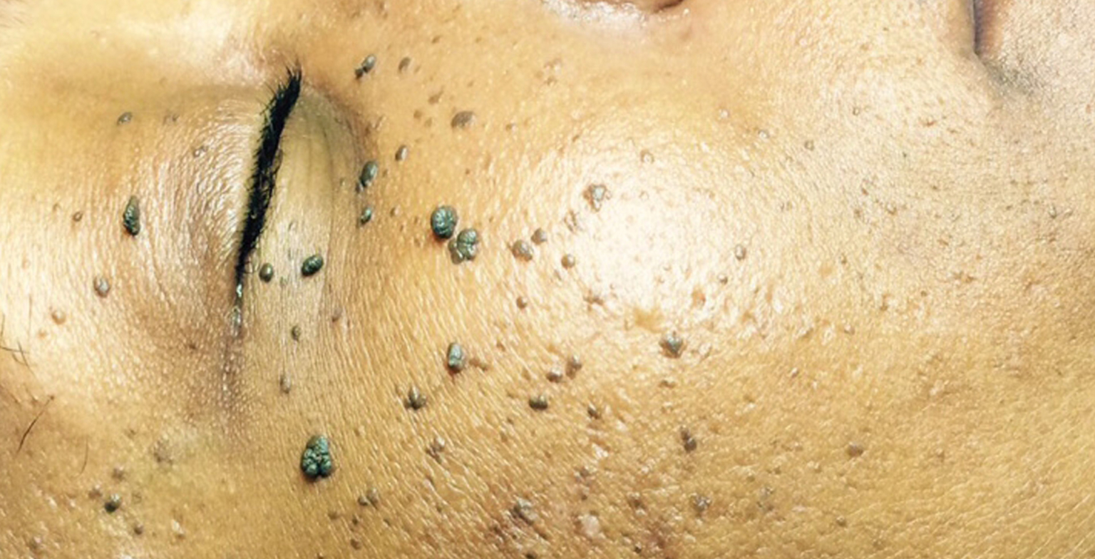 Dermatosis Papulosa Nigra (DPN) in Croydon | JH Skincare Clinic | IPL ...